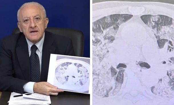 Covid, De Luca mostra in diretta anche una Tac polmonare - TerranostraNews